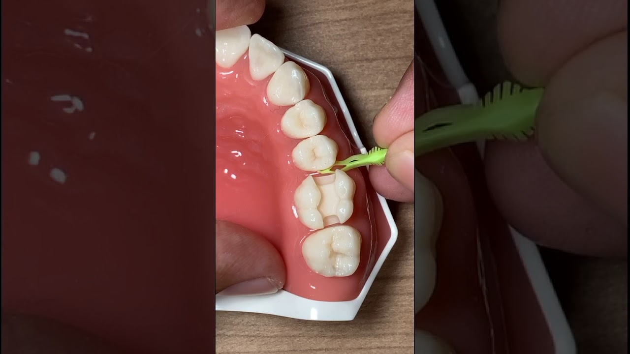 Webinar Live Instagram about first upper molar composite - YouTube