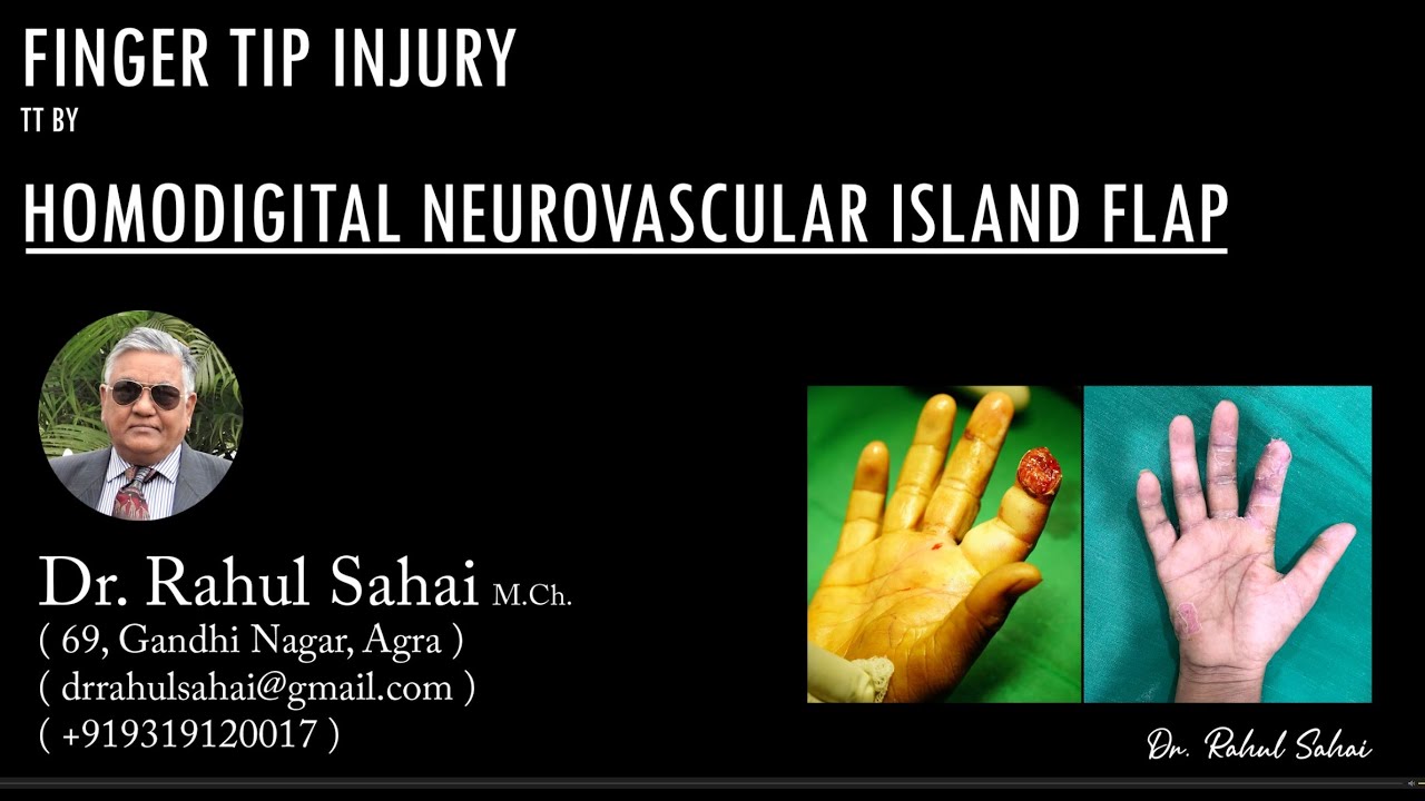 FINGER TIP RECONSTRUCTION by HOMODIGITAL NEUROVASCULAR FLAP - YouTube