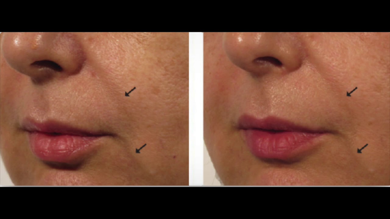Oxy Infusion Facial Treatment - YouTube