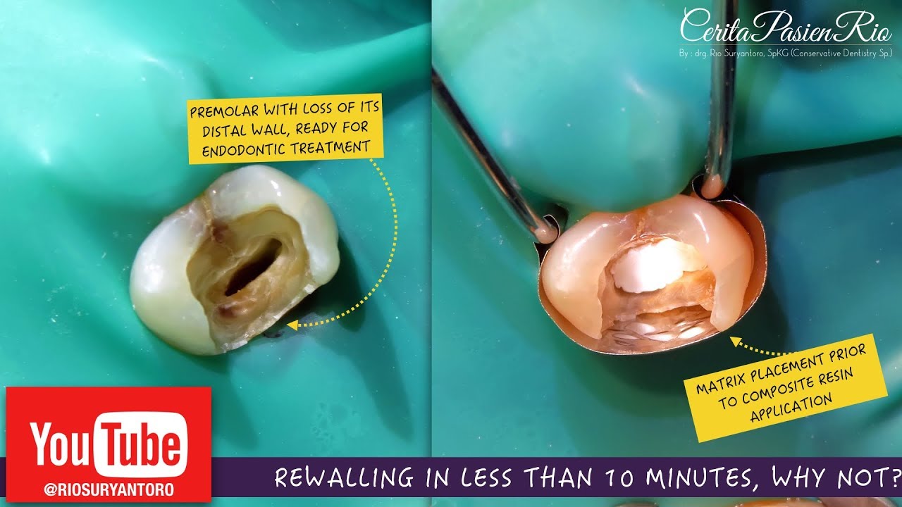 rebuild up the tooth during endodontic - root canal - treatment - voco ...