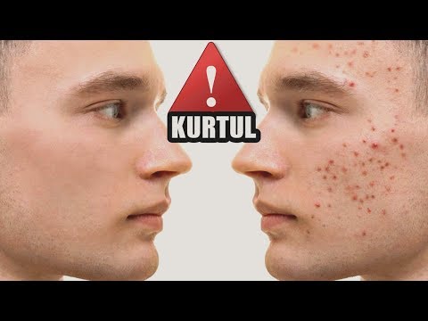 Sivilce ve Cilt İzleri Nasıl Geçer ? ( GEÇ KALMAYIN ! ) Ergenlik Dönemindekilere Tavsiyeler