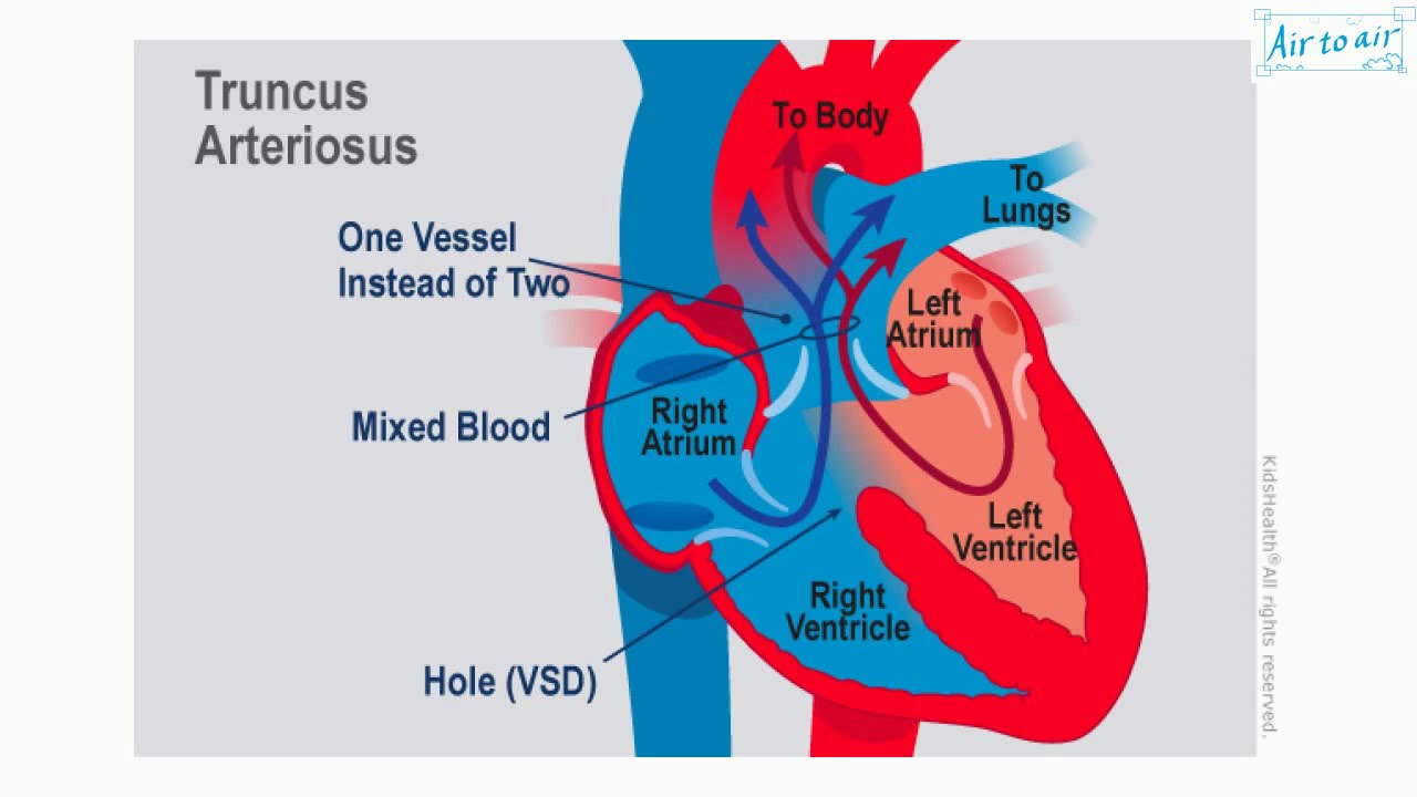 truncus arteriosus - YouTube