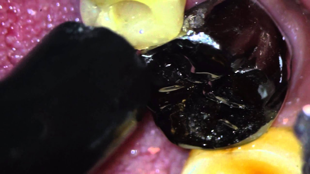 Radix Anker under Zumax - YouTube