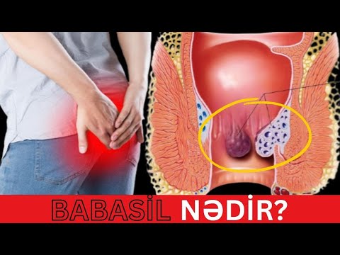 Xroniki qəbizlik, İshal - BABASİL xəstəliyinə səbəb ola bilər?