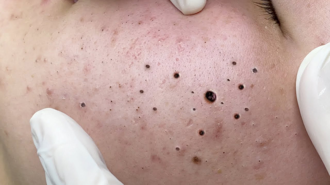 Blackheads & Acne Treatment Latest Update 27 - YouTube