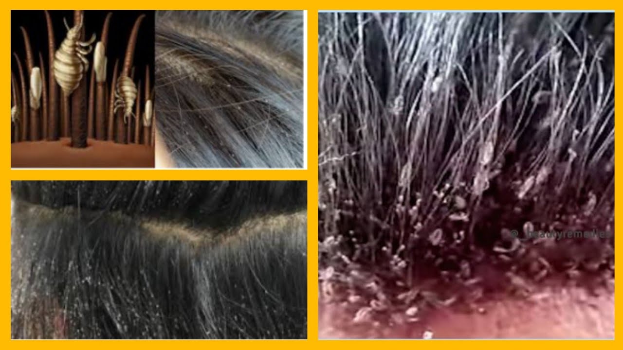 Best Anti Lice Remedy||How To Get Rid of Lice||Remove Lice with 1 ...