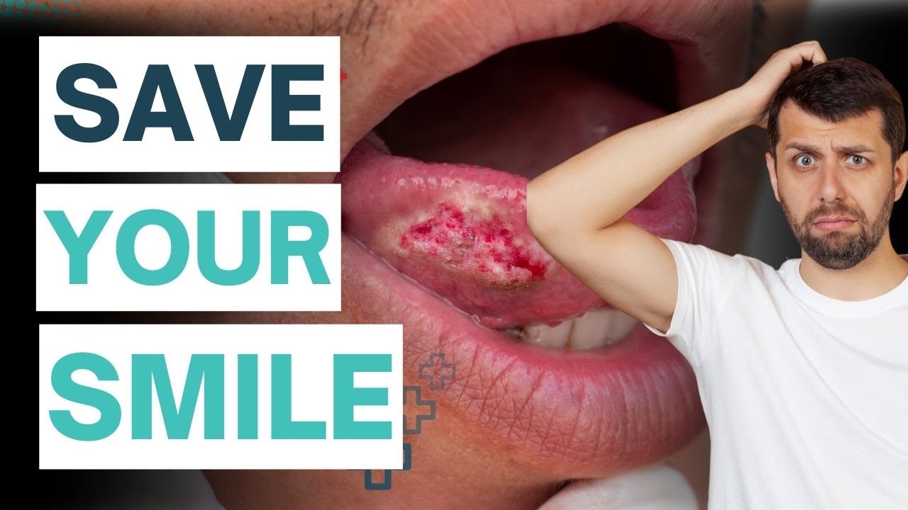 [Oral Cancer Prevention] Betel Nuts Health Hazards, Prevention ...