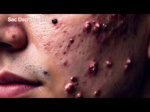 sac dep spa big deep blackheads ASMR | sac dep spa pimple popping ...