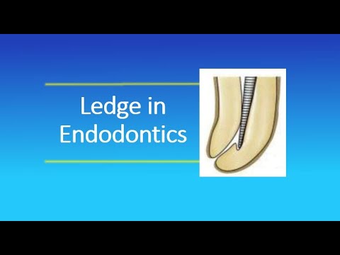 What is Ledge in Endodontics?? - YouTube