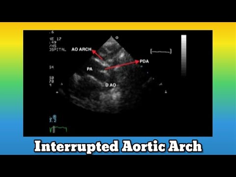 Interrupted Aortic Arch - YouTube
