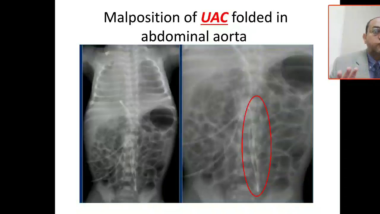 Case 14 malposition of umbilical artery catheterization UAC - YouTube