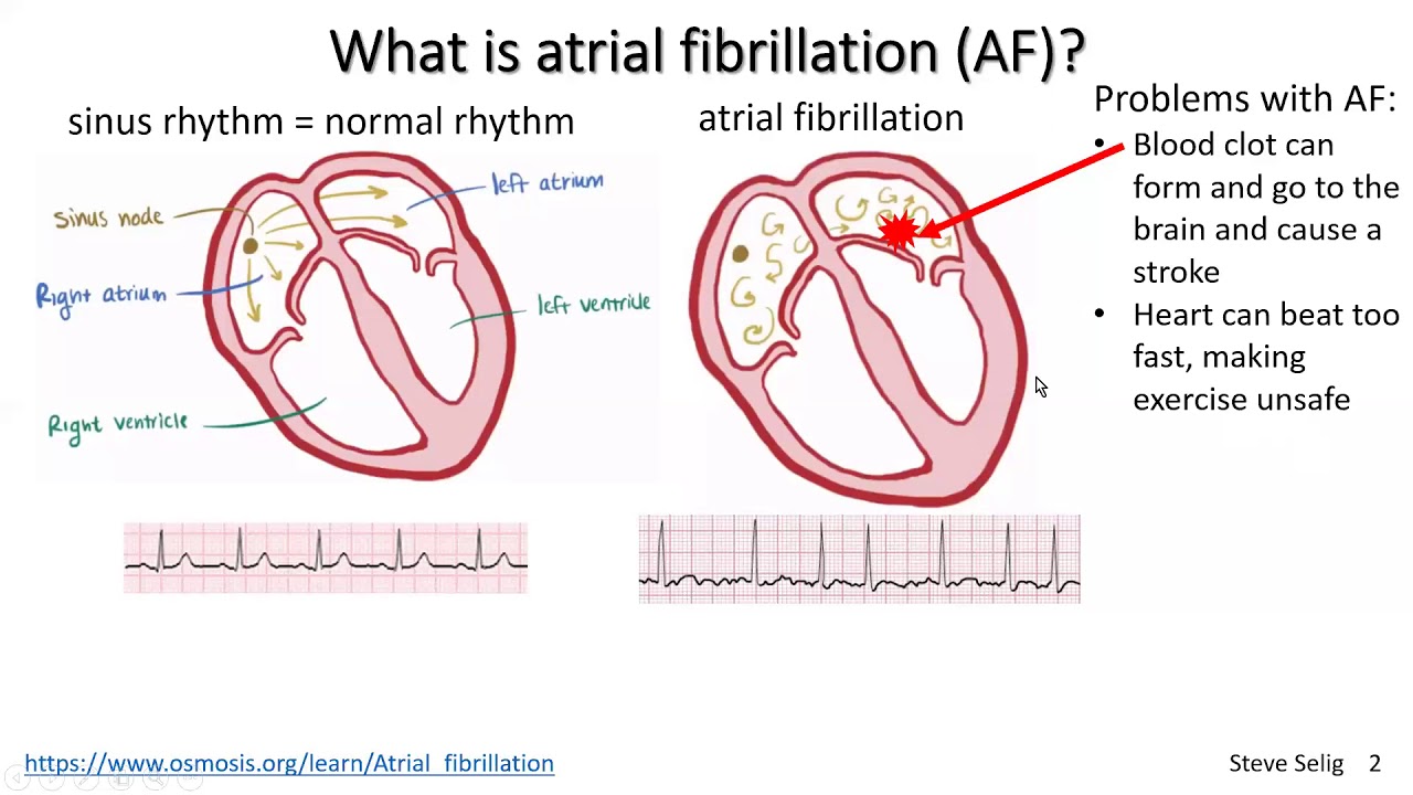 Atrial fibrillation and exercise: part 6: summary: what is AF ...
