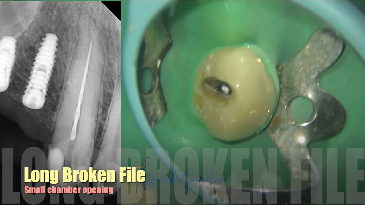 Long Broken File Removal / Loop technique / Ultra X - YouTube