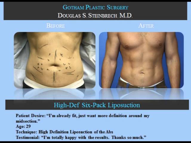 Liposuction Men Abs
