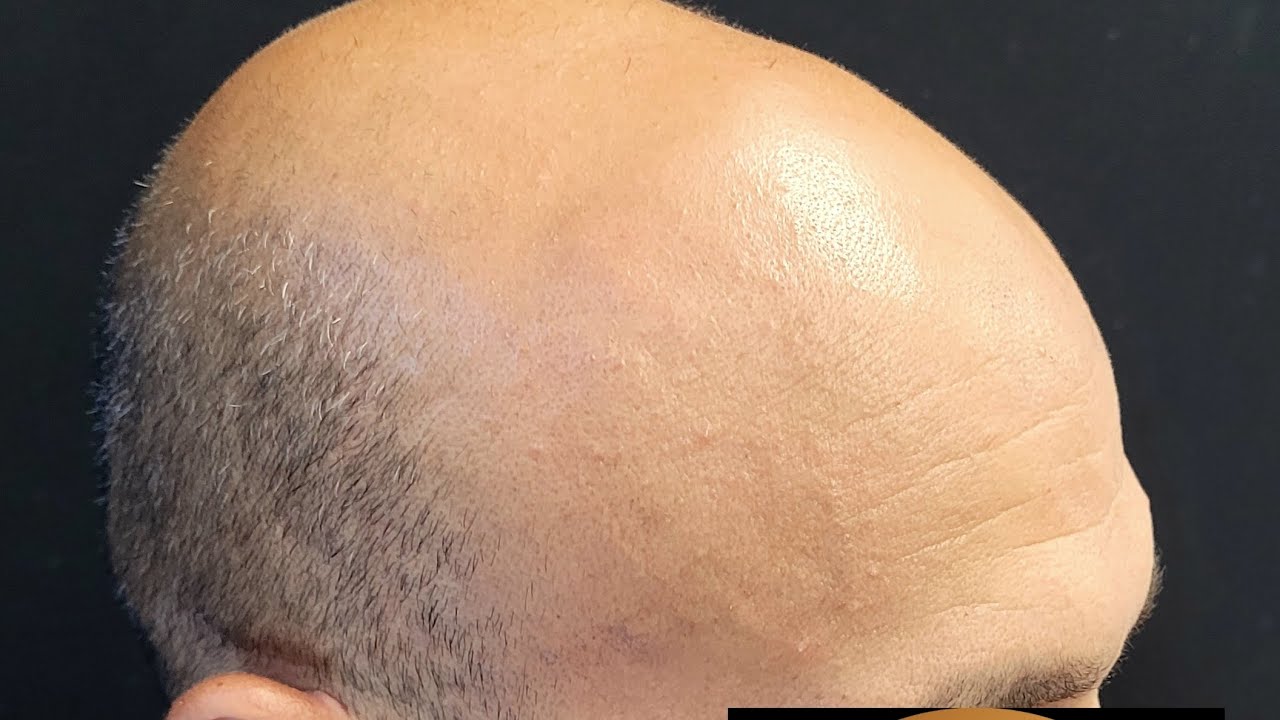 Amazing SMP (Scalp Micropigmentation) transformation . - YouTube