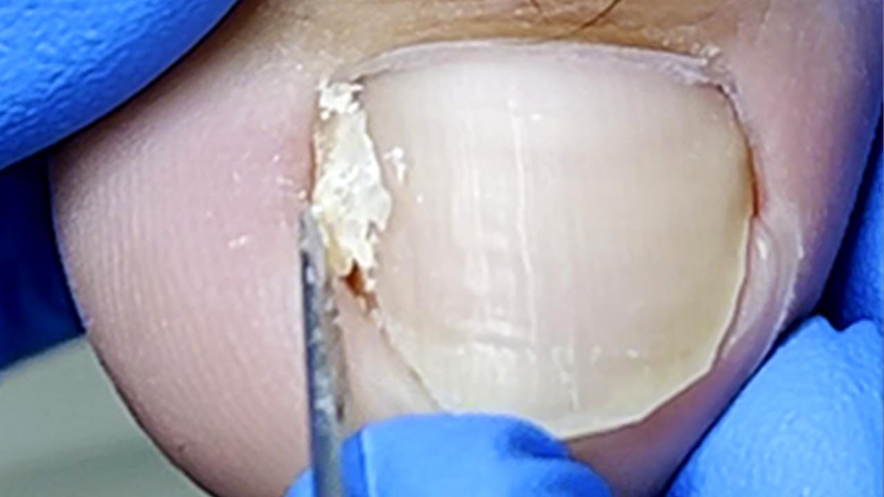 The ingrown nail at the root is very deep!【Xue Yidao Pedicure】 - YouTube