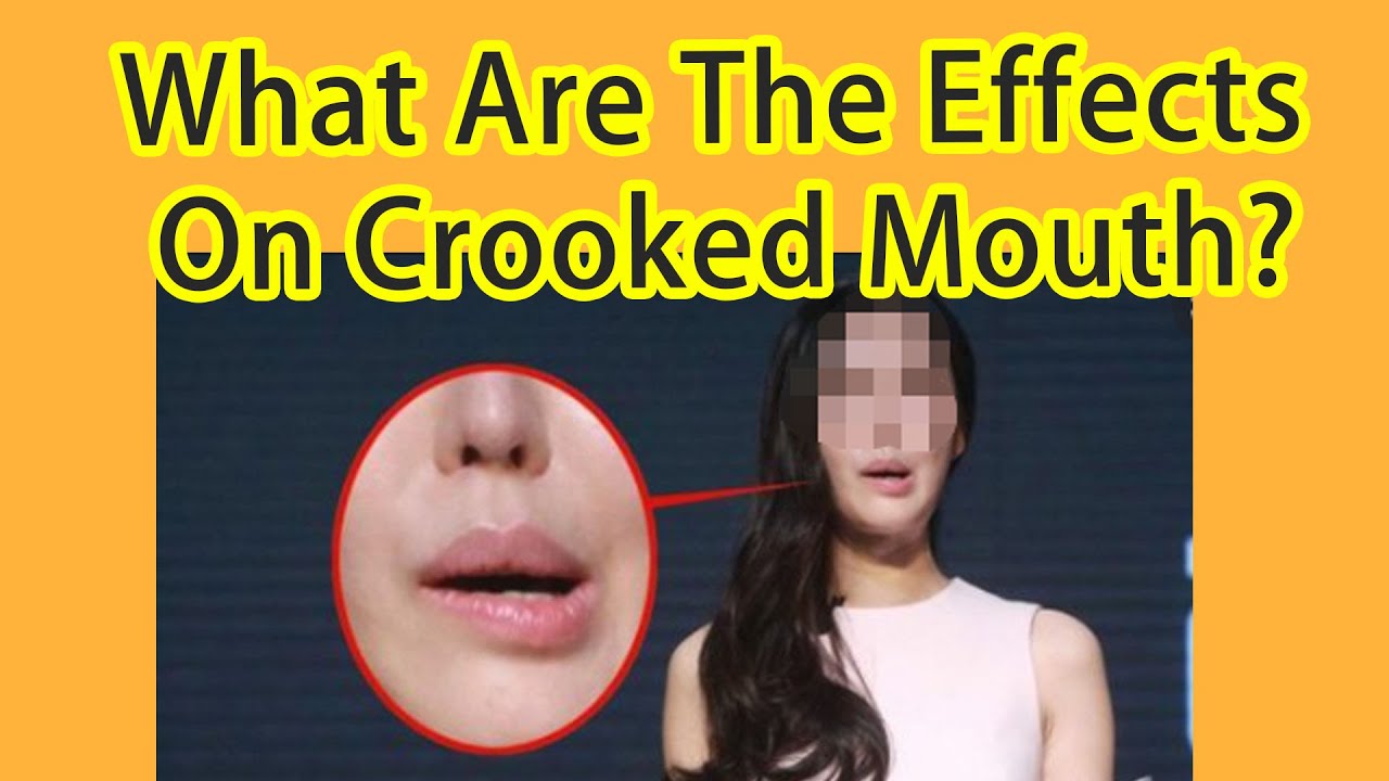 What Are The Effects On Crooked Mouth? What you should do if your mouth ...
