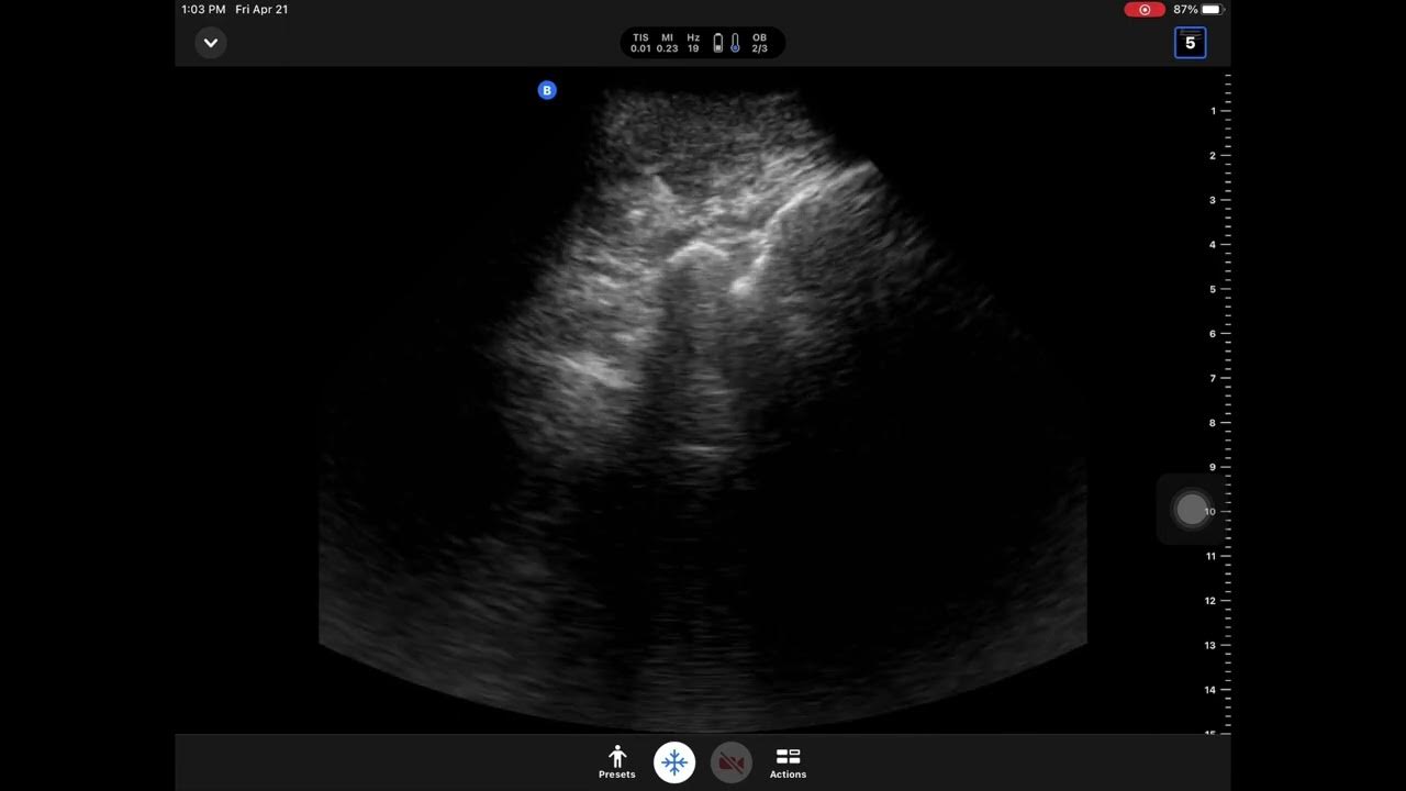 Bilateral ESP block at L5 Level - YouTube