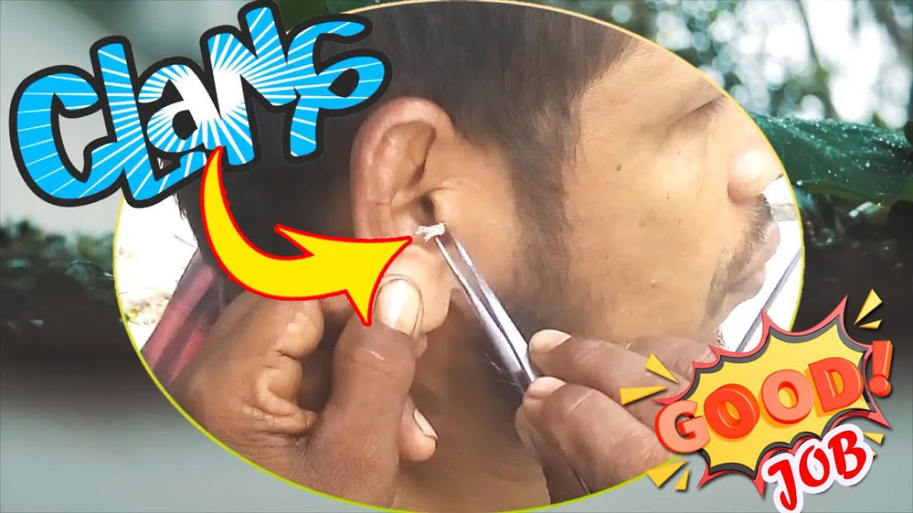 Dry Earwax and White Dirt's Removal ASMR / Most Satisfying Ear Cleaning ...