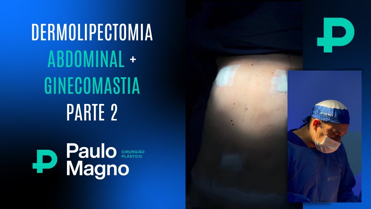 Dermolipectomia abdominal + ginecomastia - PARTE 2 - YouTube