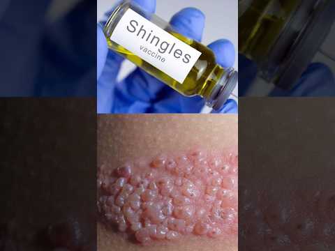 How Chicken Pox Leads to Shingles (Herpes Zoster) #chickenpox #shingles #vaccine #shorts #DMC
