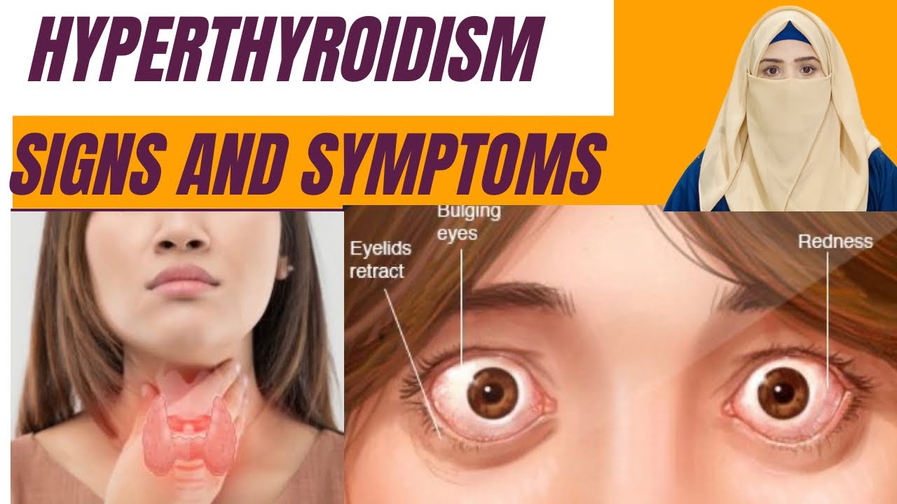HYPERTHYROIDISM | Signs and Symptoms | Causes and Diagnosis - YouTube