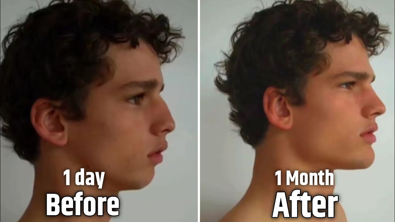 Fix Your Recessed Chin Because of THIS (Not Genetics) - YouTube