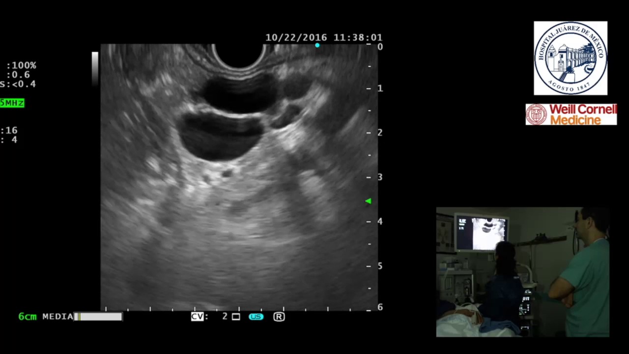 Endoscopic Ultrasound (EUS) for differential diagnosis in pancreas at ...