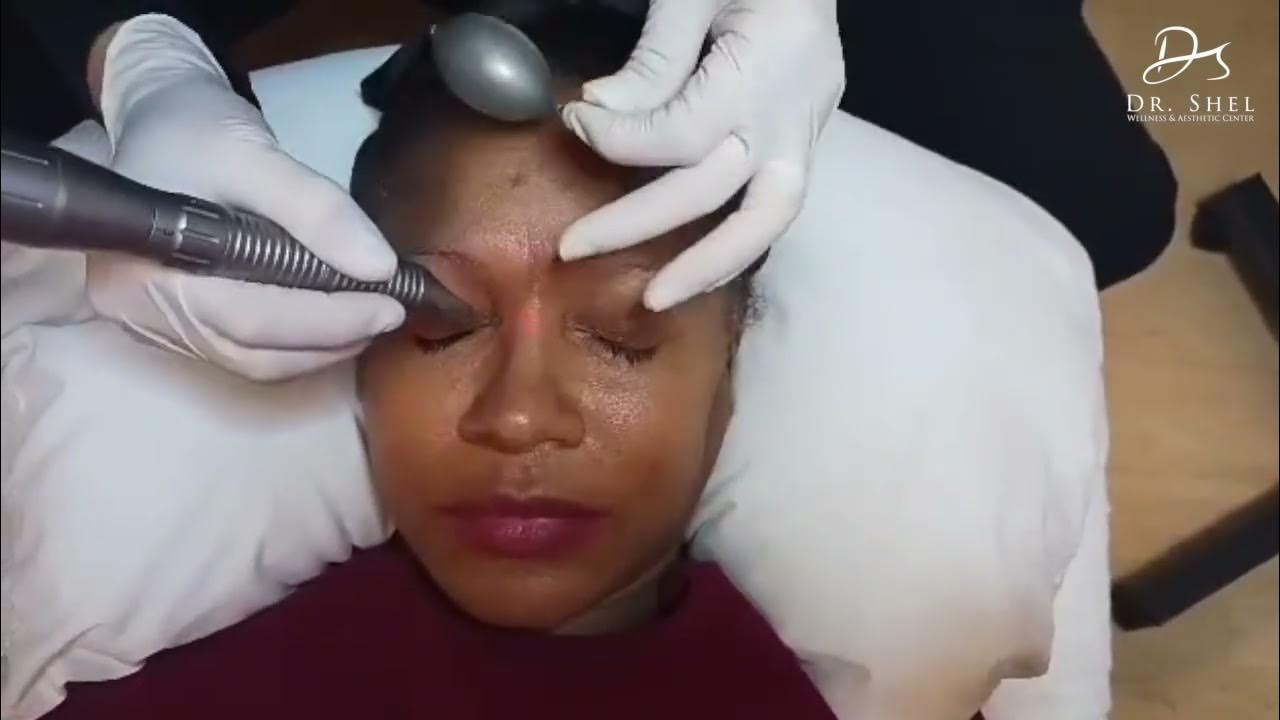 Fotona Eyelase | Dr. Shel Wellness & Aesthetic Center - YouTube