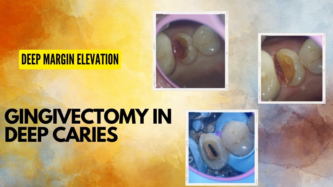 GINGIVECTOMY IN DEEP CLASS 2 RESTORATION | PREENDOBUILDUP TIPS AND ...