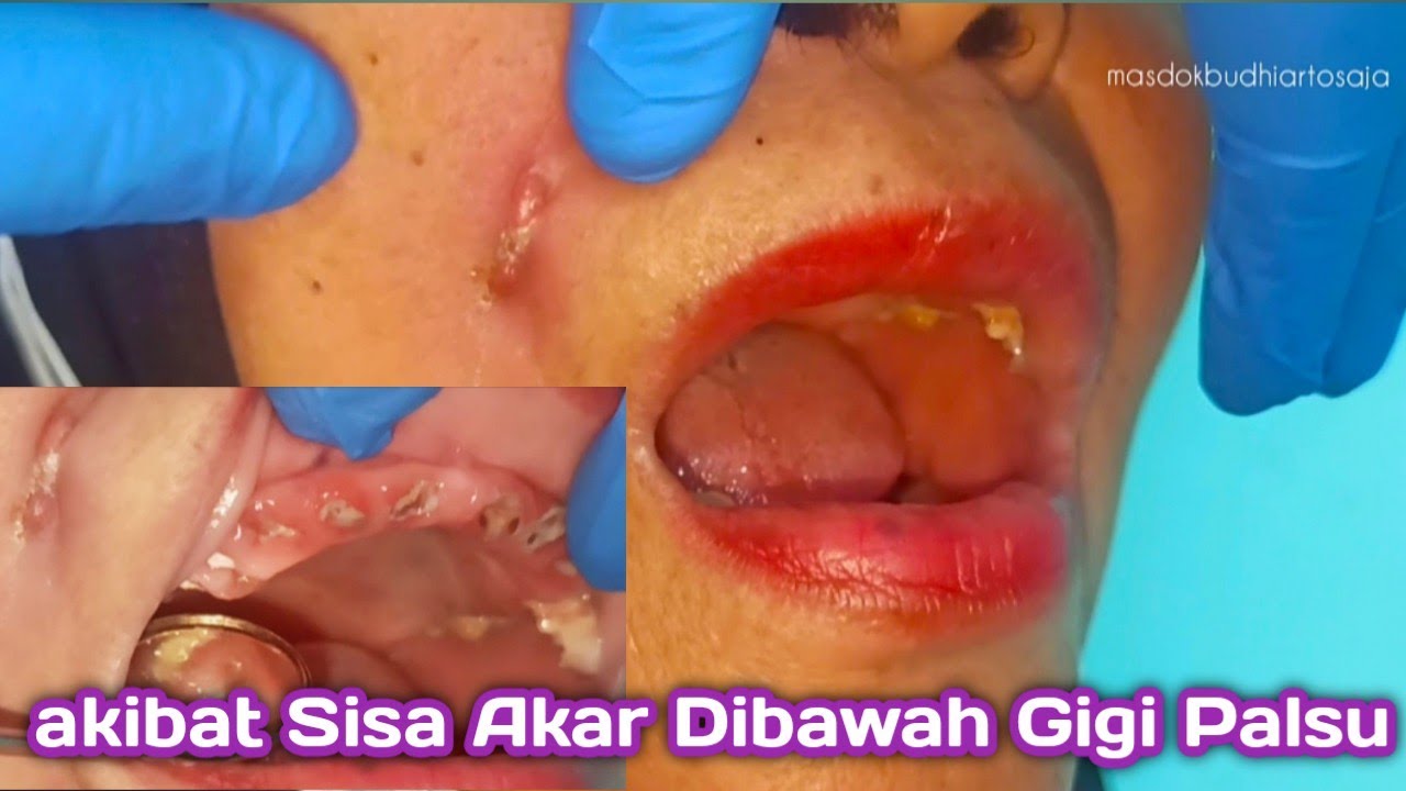 Akibat Sisa Akar Gigi Dan Gigi Palsu Yang Dibuat Seadanya - YouTube