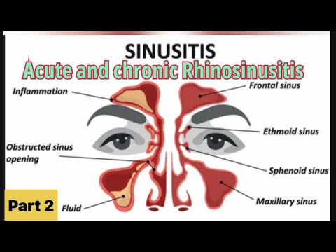 Acute and chronic Rhinosinusitis #ORL Anatomy, Physiology ,Pathology ...