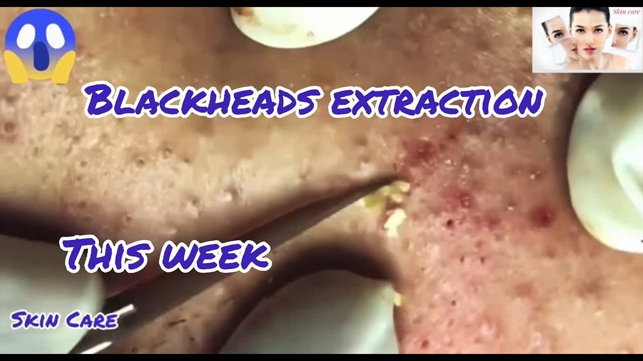 Acne extraction this week , blackheads remove ,pimple popping #32 - YouTube