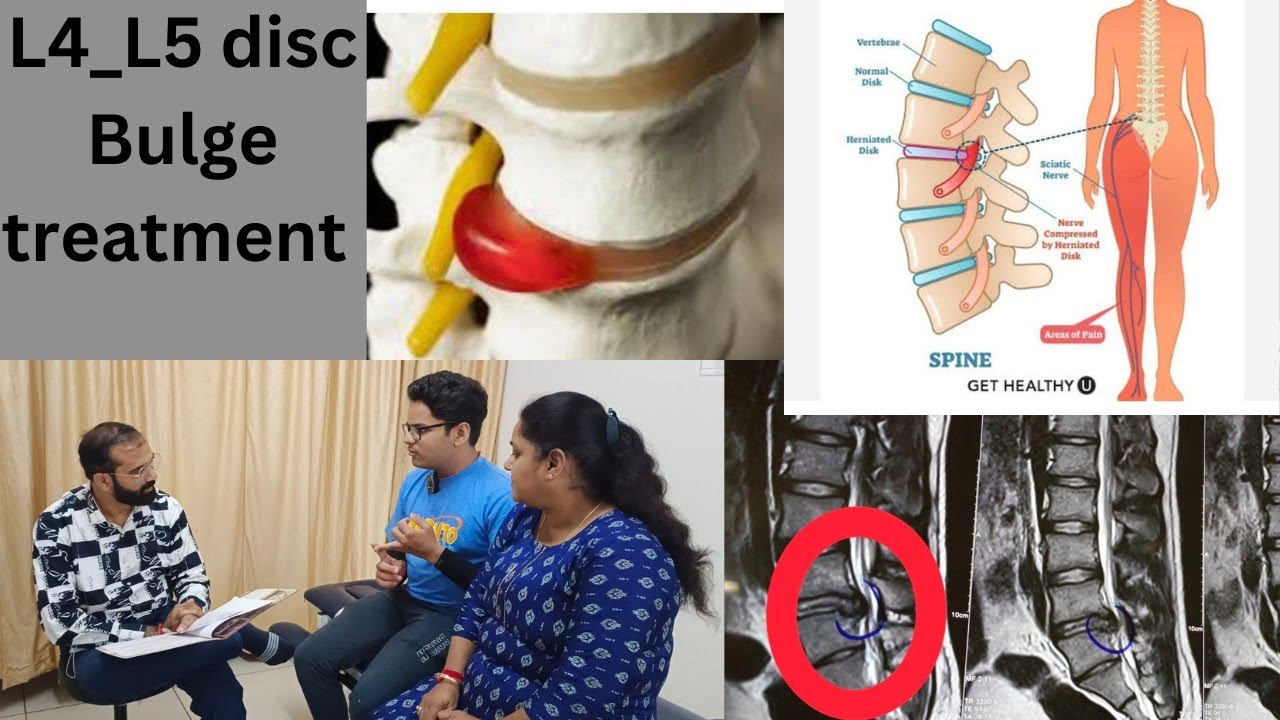 L4_L5 disc Bulge#sciatica#backpain#કમર માંથી ખસી ગયેલ ગાદી નો 100%ઇલાજ# ...