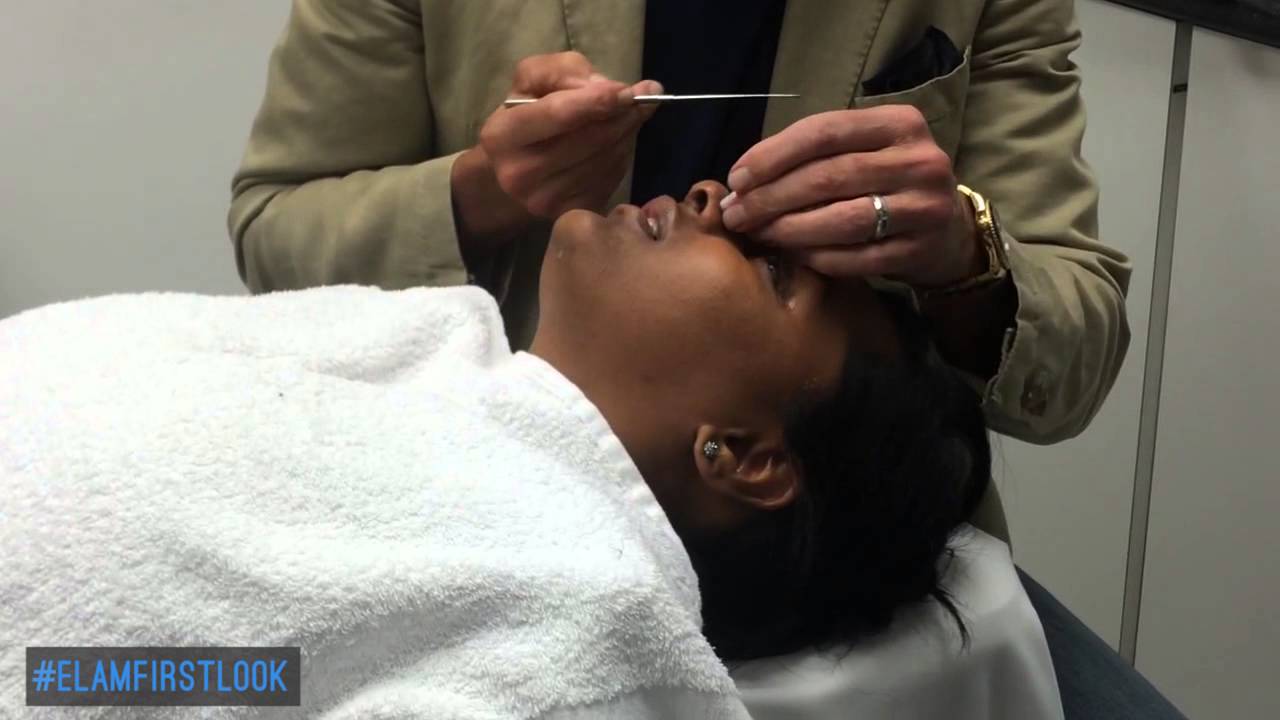 Minor Rhinoplasty (Nose Job) Surgery for Self-Improvement, Dr. Michael ...