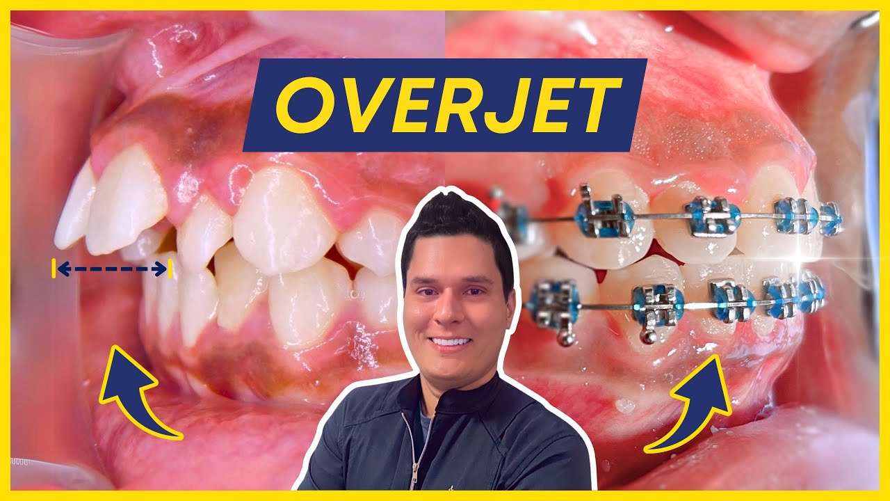 OVERJET ACENTUADO : 5 TRATAMENTOS que RESOLVEM de VEZ! - YouTube