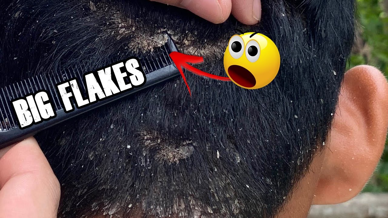 Huge Dandruff Flakes Removal on Back Side!! Dandruff Scratching ...