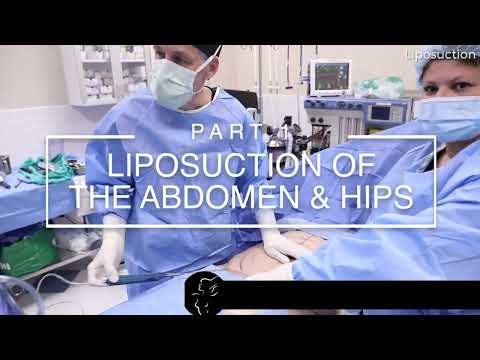 BBL After Silicone Injections Removal + Fat Transfer to the Labia and ...