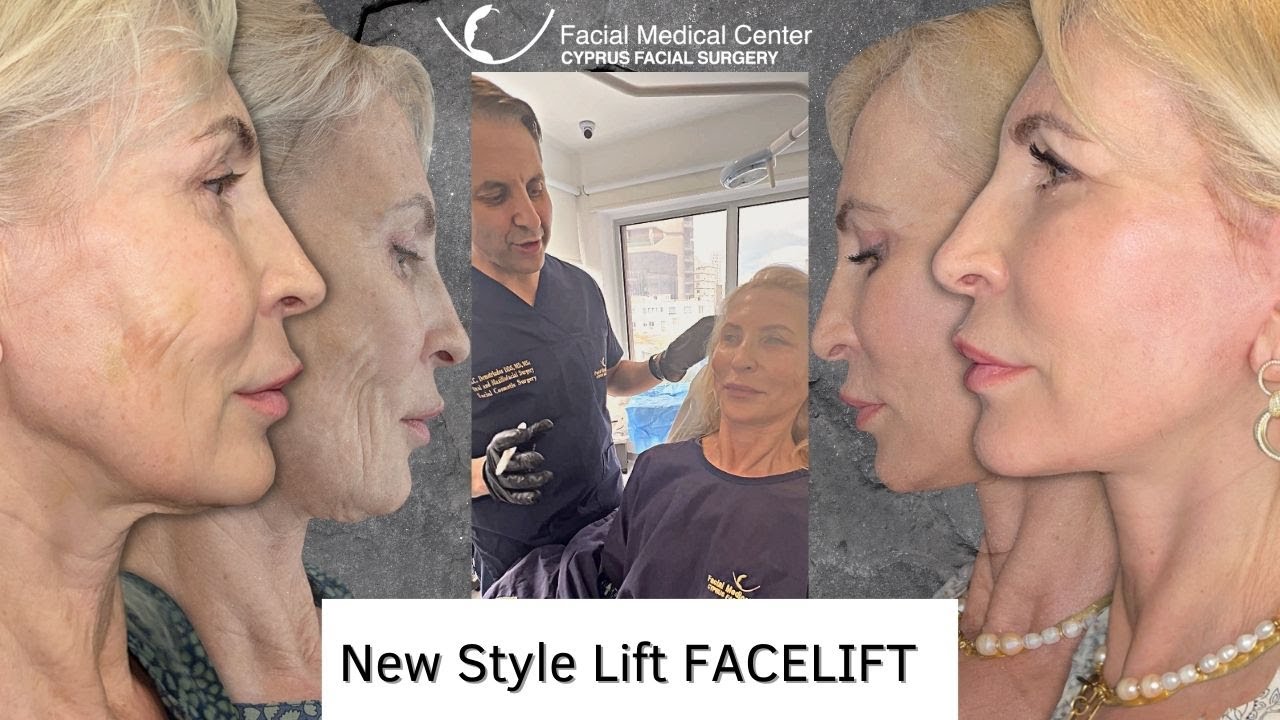 New Style Lift FACELIFT |Cyprus Facial Surgery - YouTube