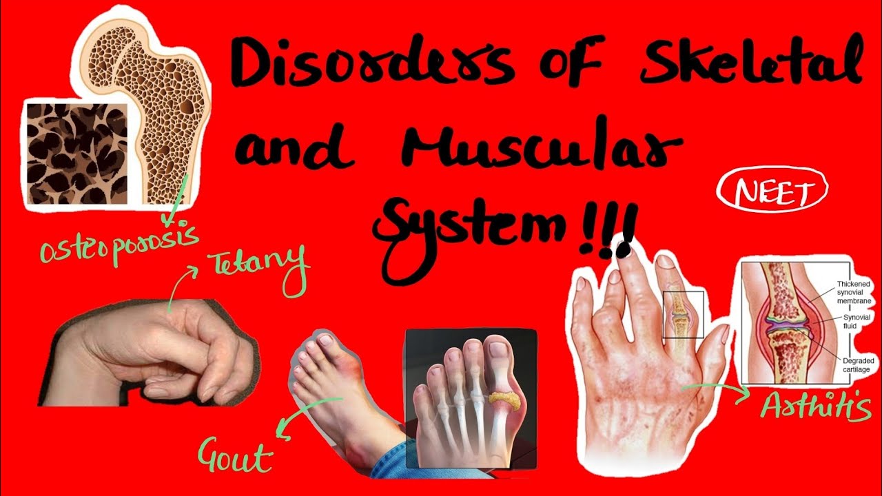 All Disorders Of Muscular And Skeletal System Class 11 Locomotion And All Disorders Of Muscular And Skeletal System Class 11 Locomotion And