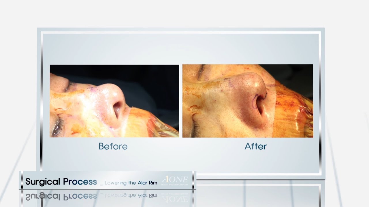 Lowering the Alar Rim - YouTube