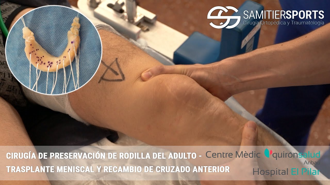 CIRUGÍA DE PRESERVACIÓN DE RODILLA DEL ADULTO TRASPLANTE MENISCO ...