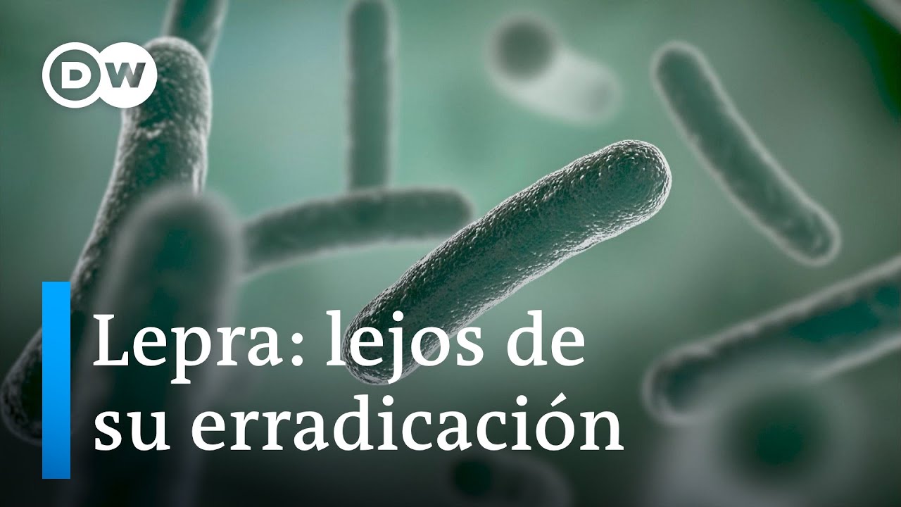 La Lepra, una enfermedad que sigue afectando a millones de personas ...