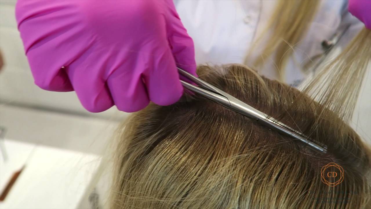 TRICHOGRAM Mikroskopowe Badanie i Analiza Włosa. dr Trycholog Gdańsk dr ...