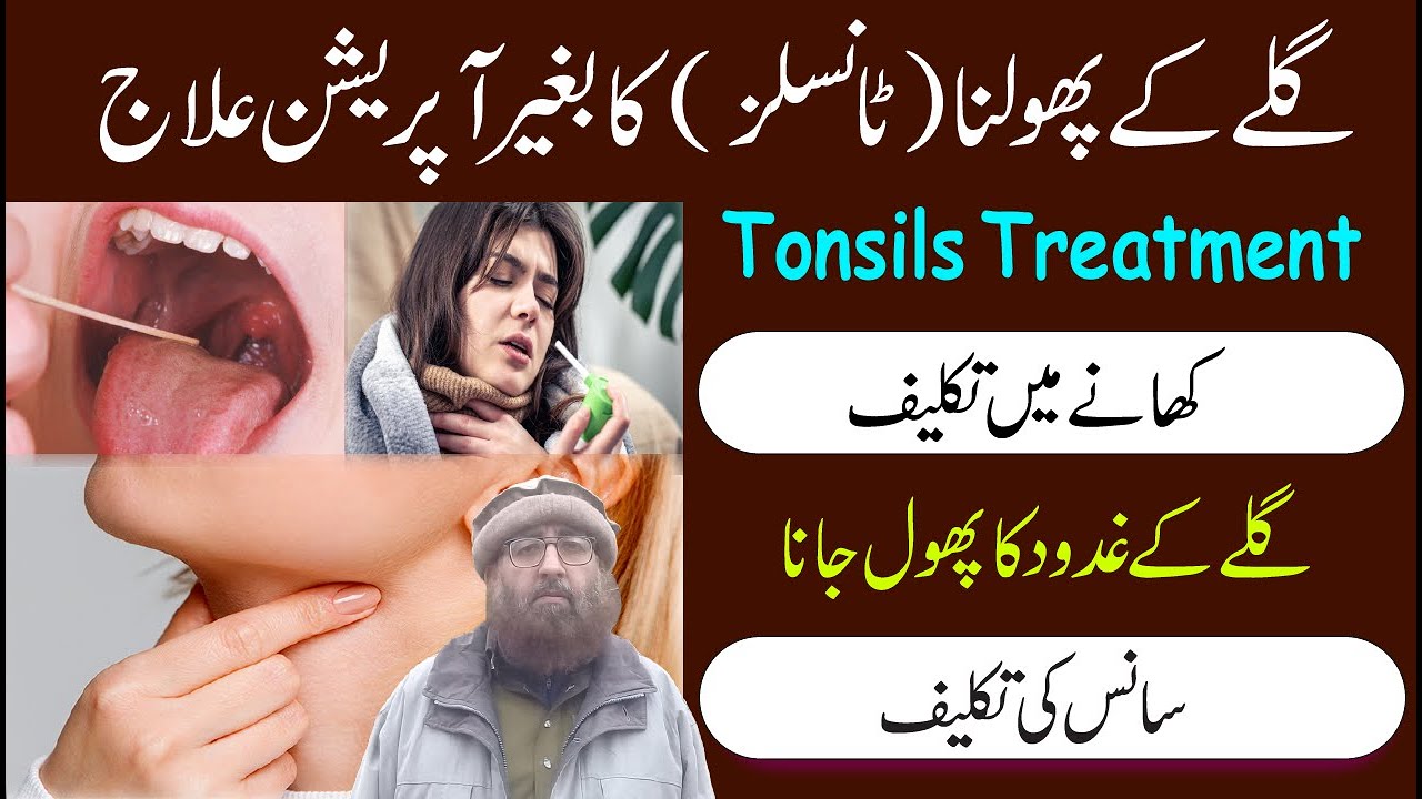bachon kh tonsils ka ilaj | Gale Ki Sujan Ka ilaj | Gale Ki gadood ka ...