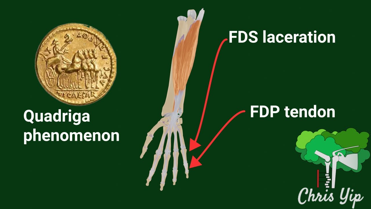 Flexor tendon injuries and the Quadriga Phenomenon (animated) - YouTube