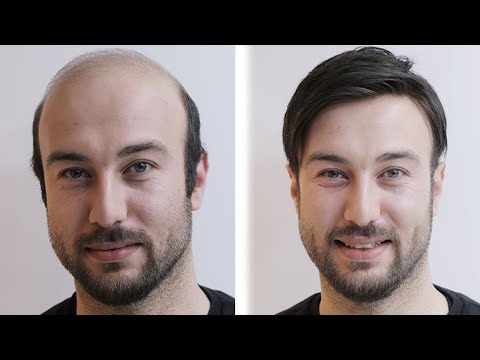 PROTEZ SAÇ - Hair Replacement