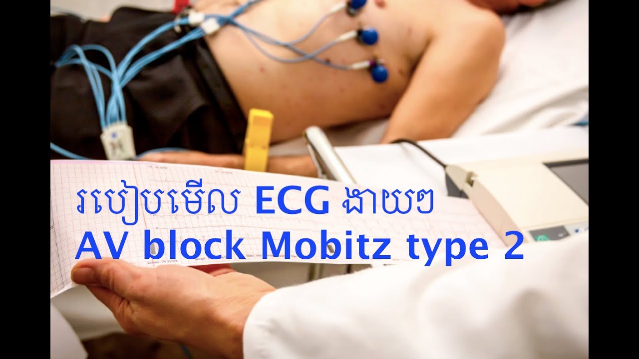 68 EKG Mobitz type 2 | ករណិសិក្សារ ECG លើអ្នកជំងឺមាន AV block type 2 ...