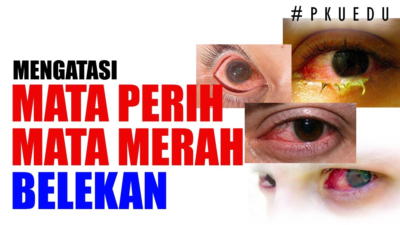 Mengatasi Mata Merah | #PKUEDU - YouTube