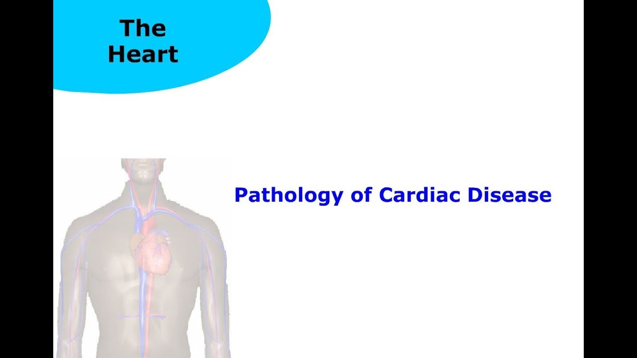 Pathology of Cardiac Disease - YouTube